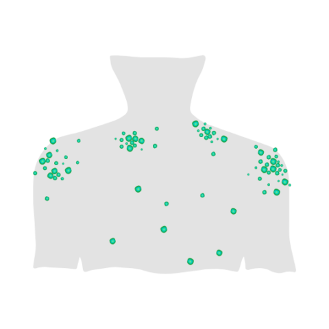 Lump And Bumps Removal Cardiff - Acorn Private Clinic